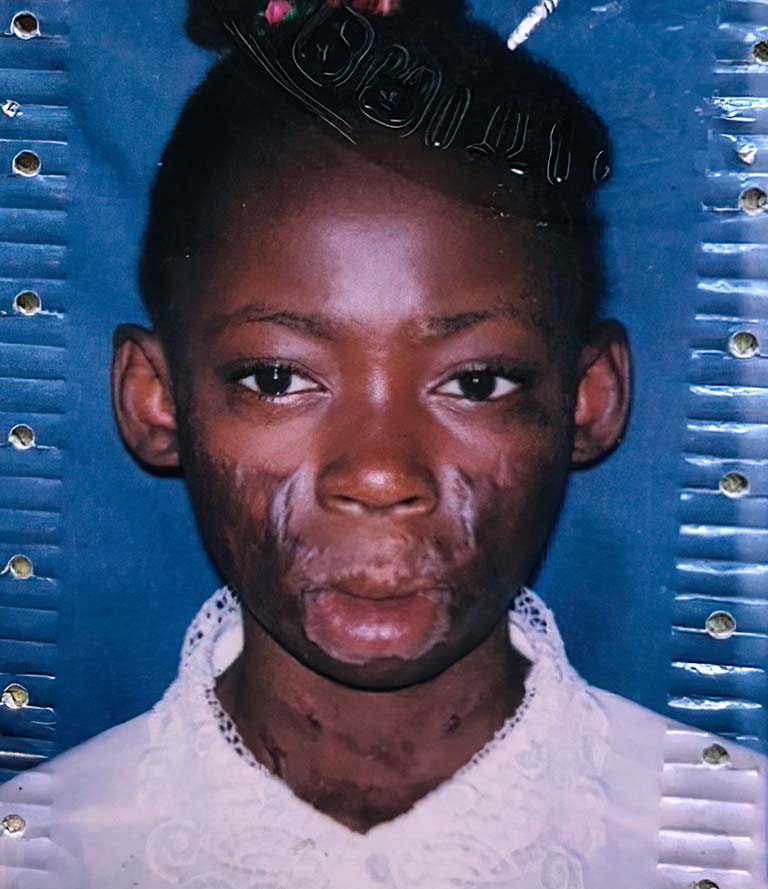 Survivor Story – Esther – Dans Fund For Burns