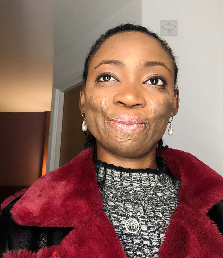 Survivor Story – Esther – Dans Fund For Burns